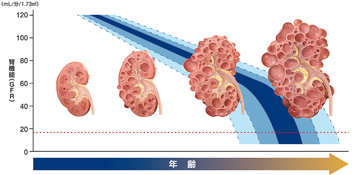 多発性嚢胞性異形成腎（MCDK）について知っておくべきこと - RxCare
